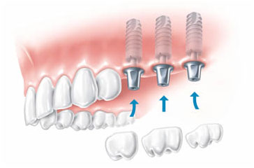 What are Dental Implants - Dental Implant India